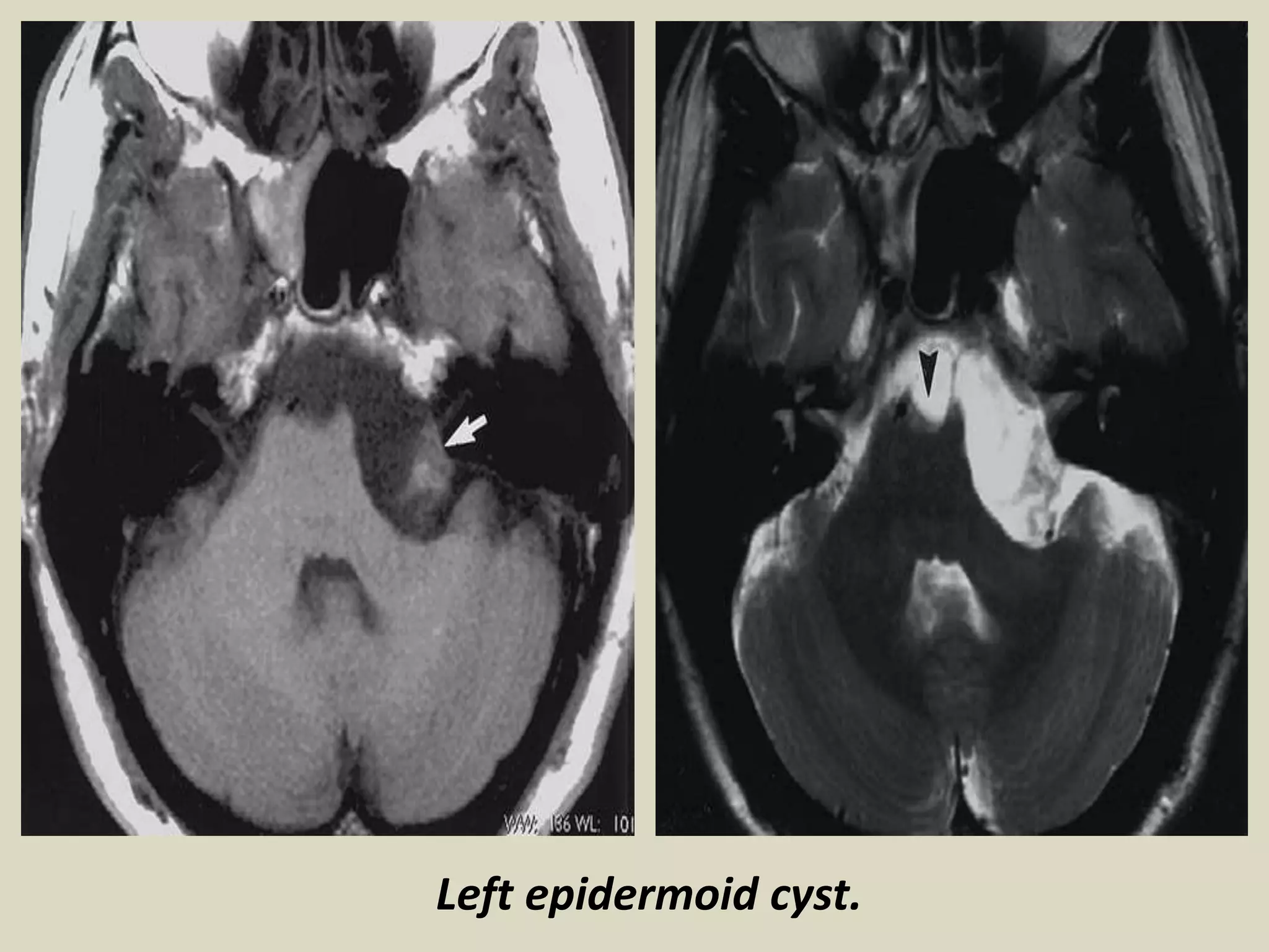 Presentation1.pptx, radiological imaging of cerebello pontine angle ...