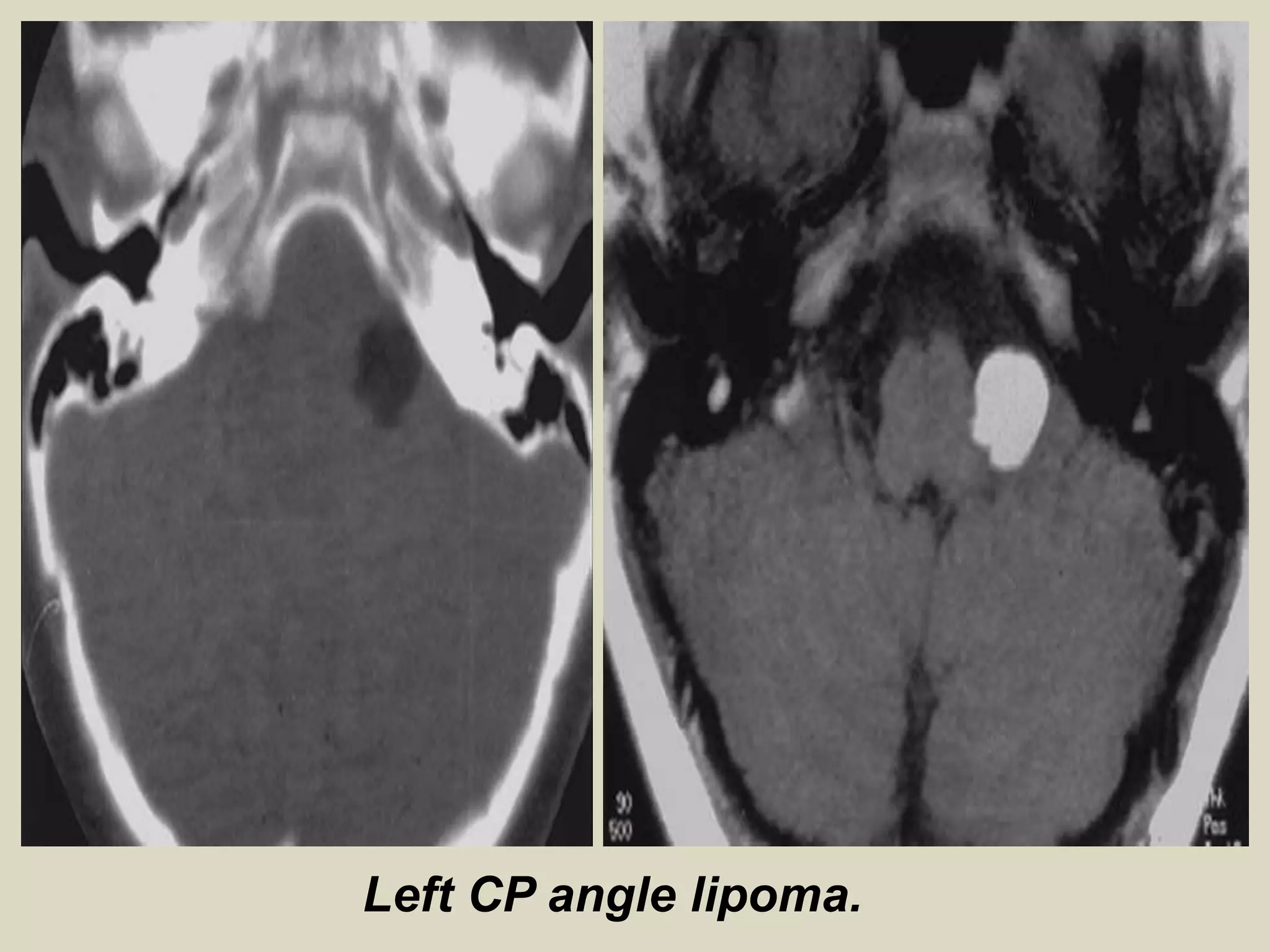 Presentation1.pptx, radiological imaging of cerebello pontine angle ...