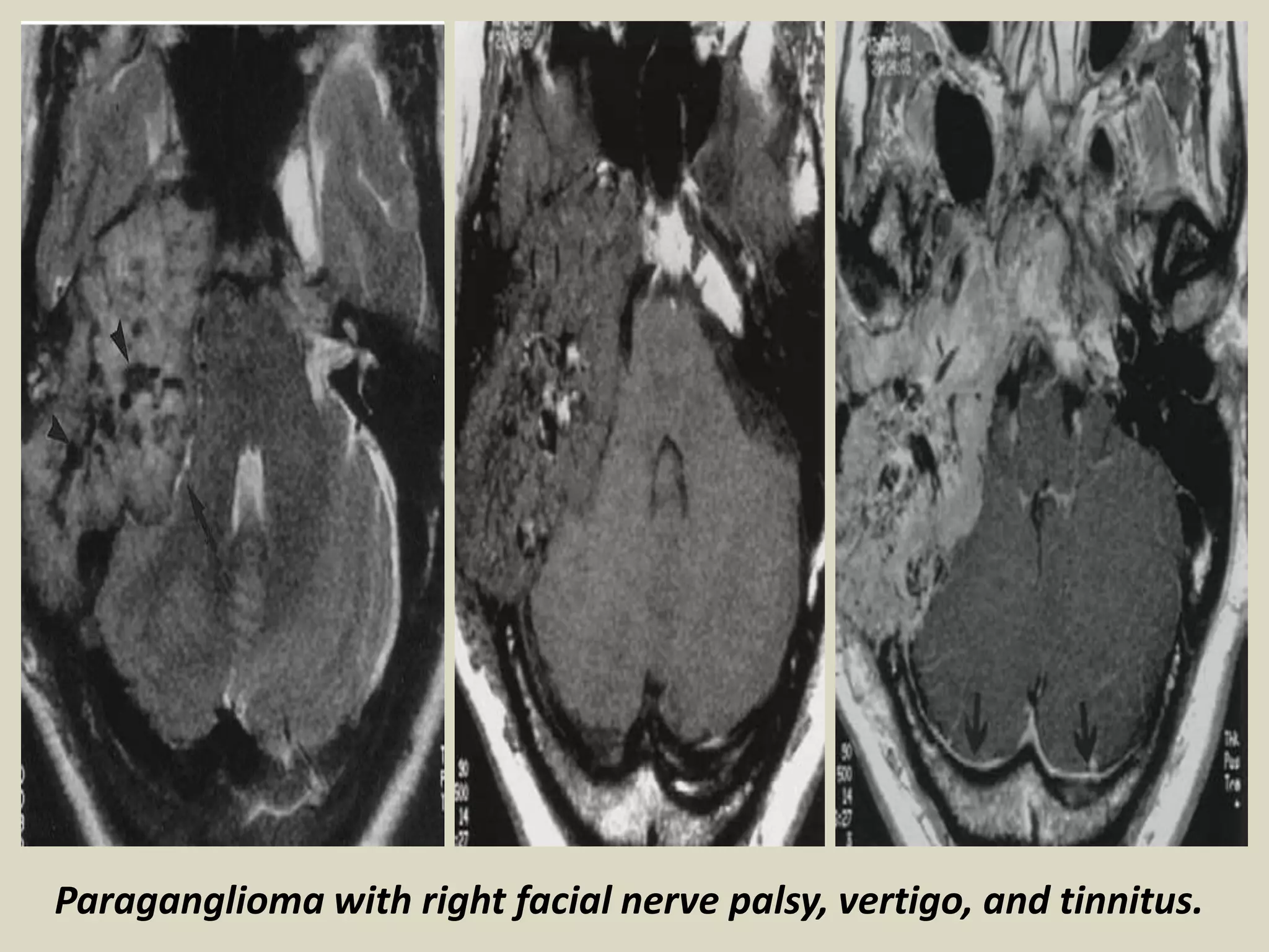 Presentation1.pptx, radiological imaging of cerebello pontine angle ...