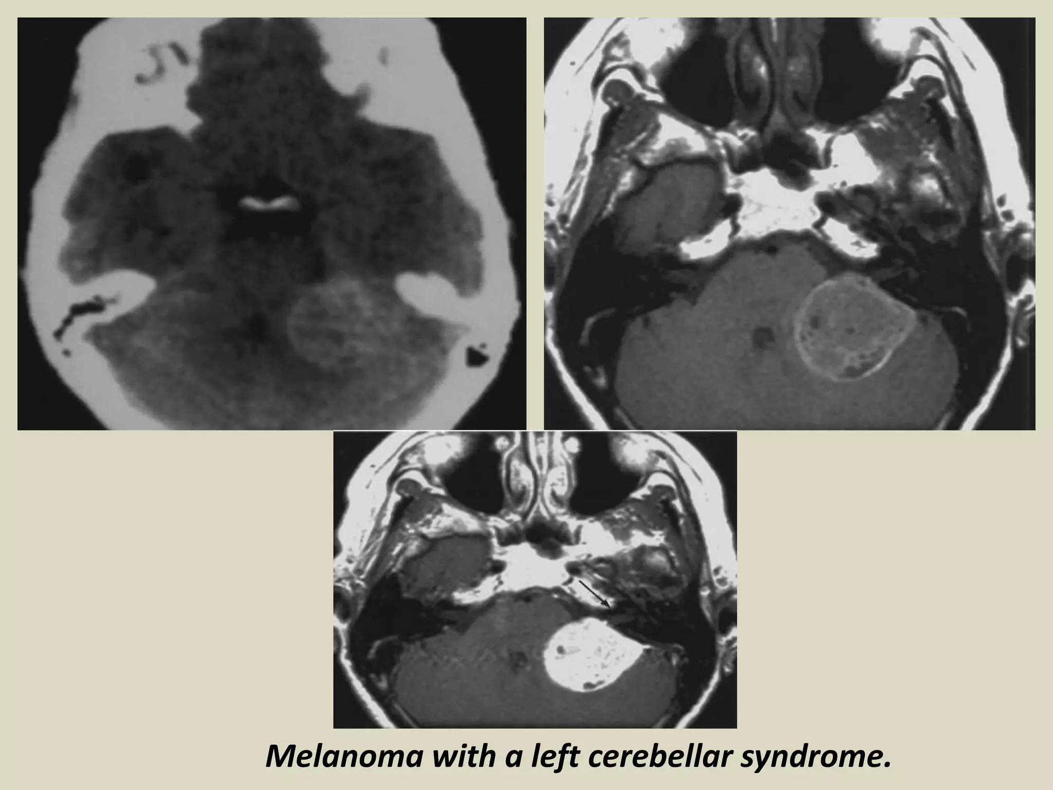 Presentation1.pptx, radiological imaging of cerebello pontine angle ...