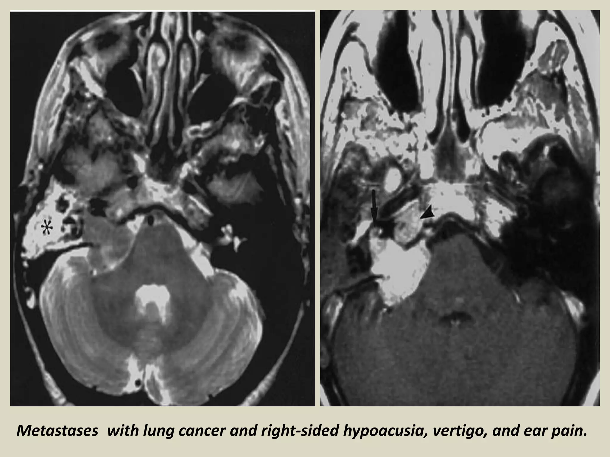 Presentation1.pptx, radiological imaging of cerebello pontine angle ...
