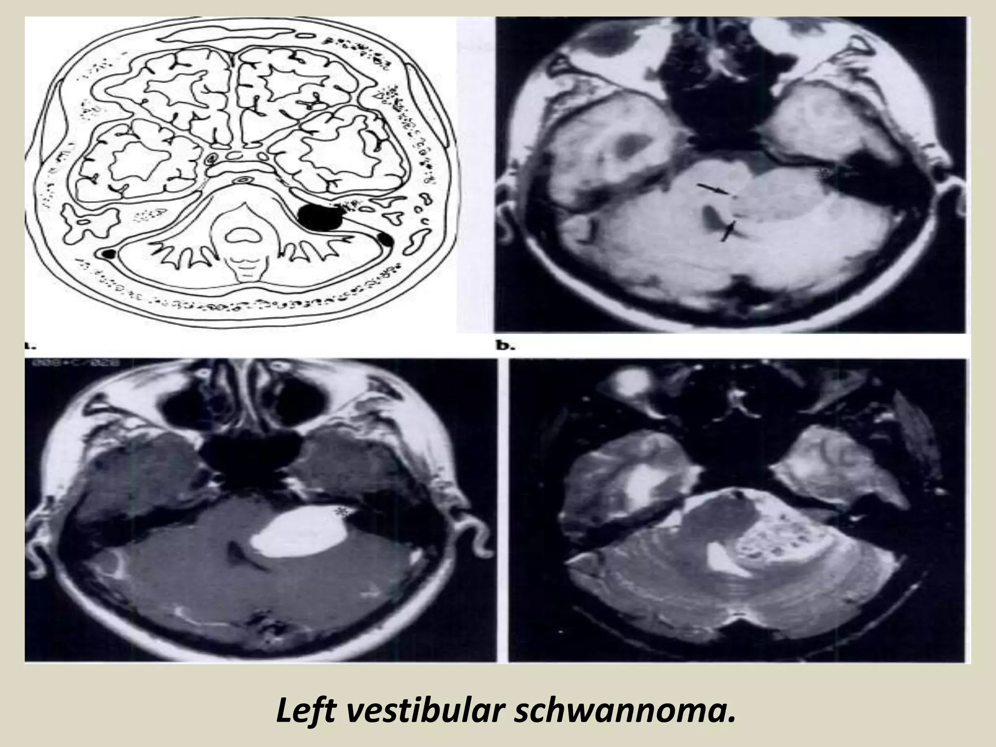 Presentation1.pptx, radiological imaging of cerebello pontine angle ...