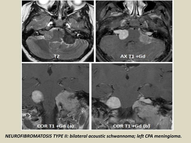 Presentation1.pptx, radiological imaging of cerebello pontine angle ...