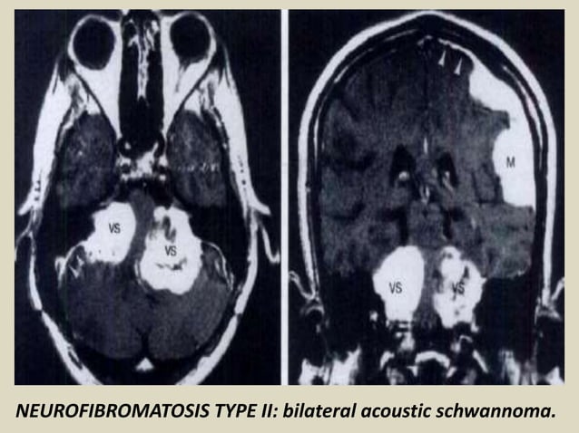 Presentation1.pptx, radiological imaging of cerebello pontine angle ...