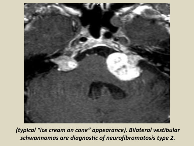 Presentation1.pptx, radiological imaging of cerebello pontine angle ...