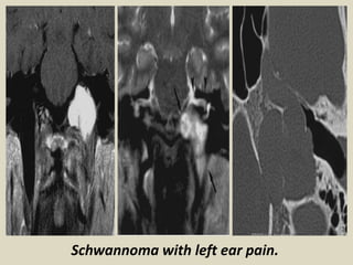 Presentation1.pptx, radiological imaging of cerebello pontine angle ...