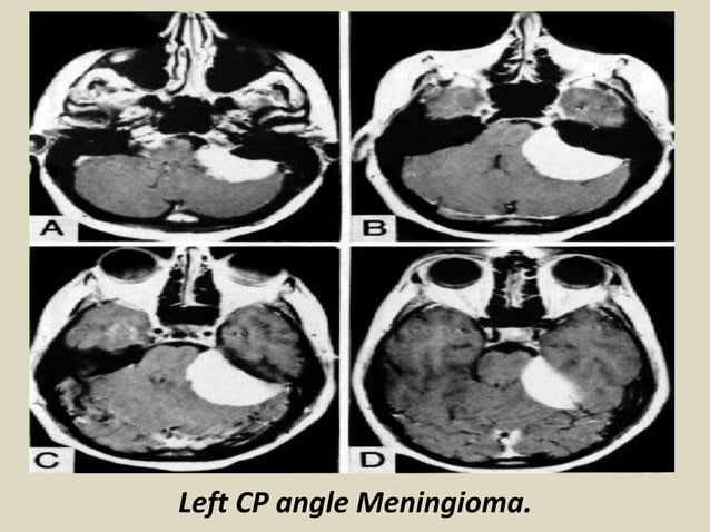 Presentation1.pptx, radiological imaging of cerebello pontine angle ...