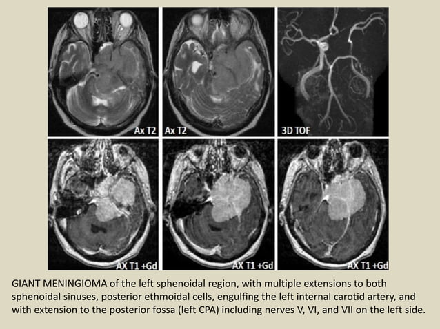 Presentation1.pptx, radiological imaging of cerebello pontine angle ...