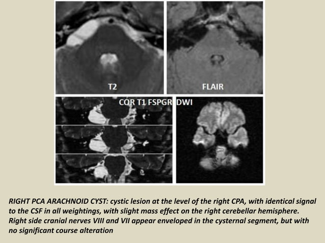 Presentation1.pptx, radiological imaging of cerebello pontine angle ...