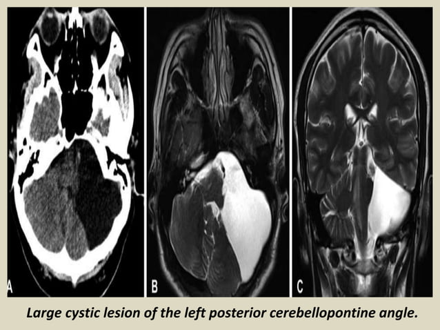 Presentation1.pptx, radiological imaging of cerebello pontine angle ...