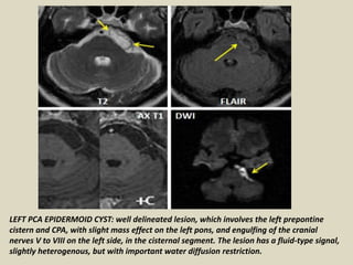 Presentation1.pptx, radiological imaging of cerebello pontine angle ...