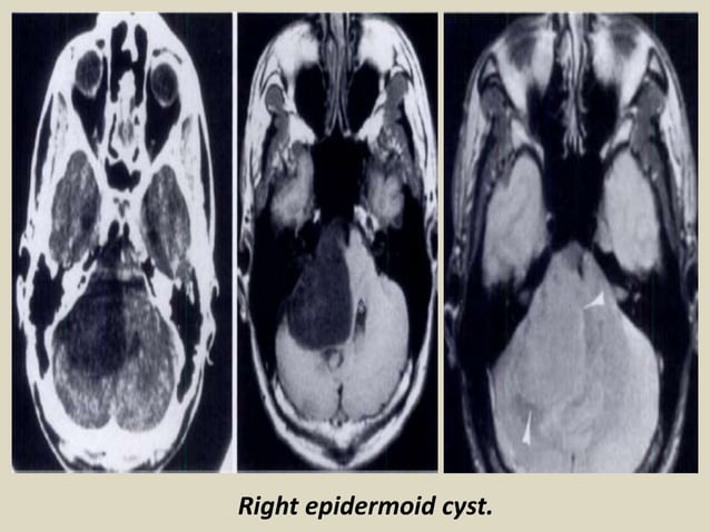 Presentation1.pptx, radiological imaging of cerebello pontine angle ...