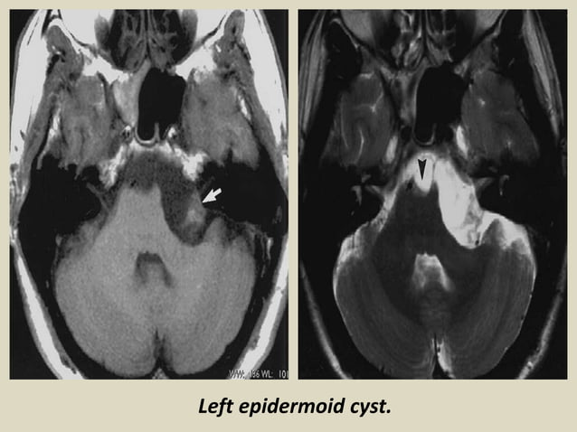 Presentation1.pptx, radiological imaging of cerebello pontine angle ...