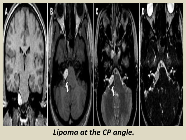 Presentation1.pptx, radiological imaging of cerebello pontine angle ...