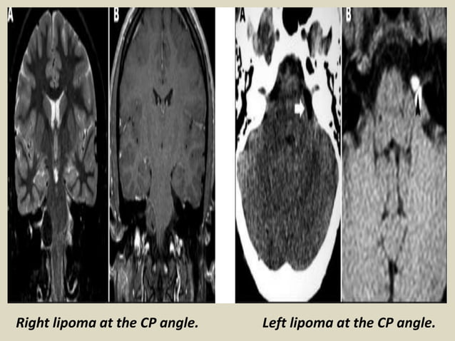 Presentation1.pptx, radiological imaging of cerebello pontine angle ...