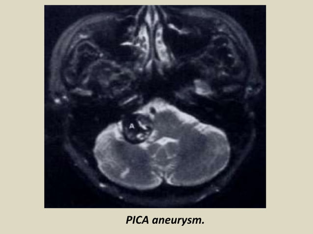 Presentation1.pptx, radiological imaging of cerebello pontine angle ...
