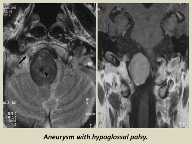 Presentation1.pptx, radiological imaging of cerebello pontine angle ...