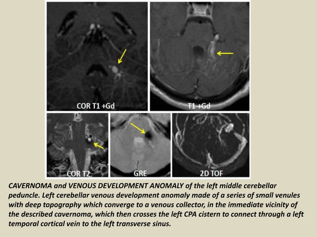 Presentation1.pptx, radiological imaging of cerebello pontine angle ...