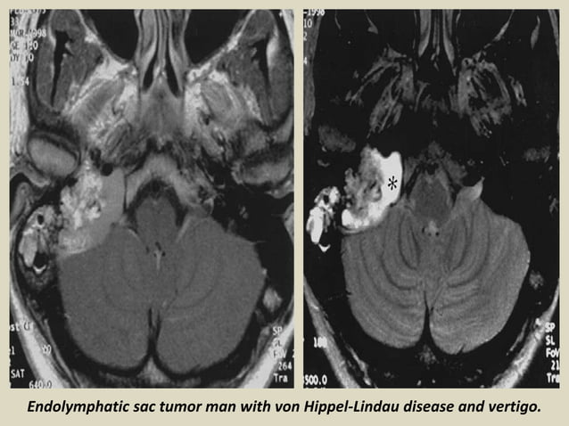 Presentation1.pptx, radiological imaging of cerebello pontine angle ...