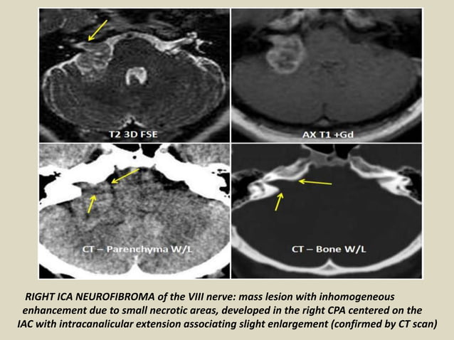 Presentation1.pptx, radiological imaging of cerebello pontine angle ...