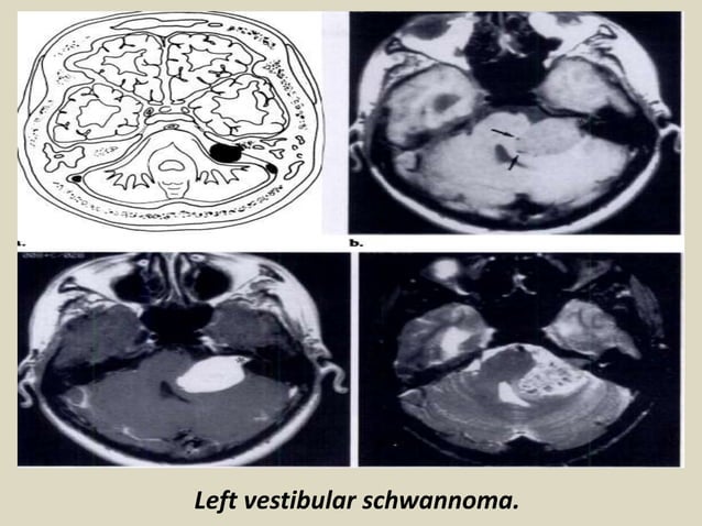 Presentation1.pptx, radiological imaging of cerebello pontine angle ...
