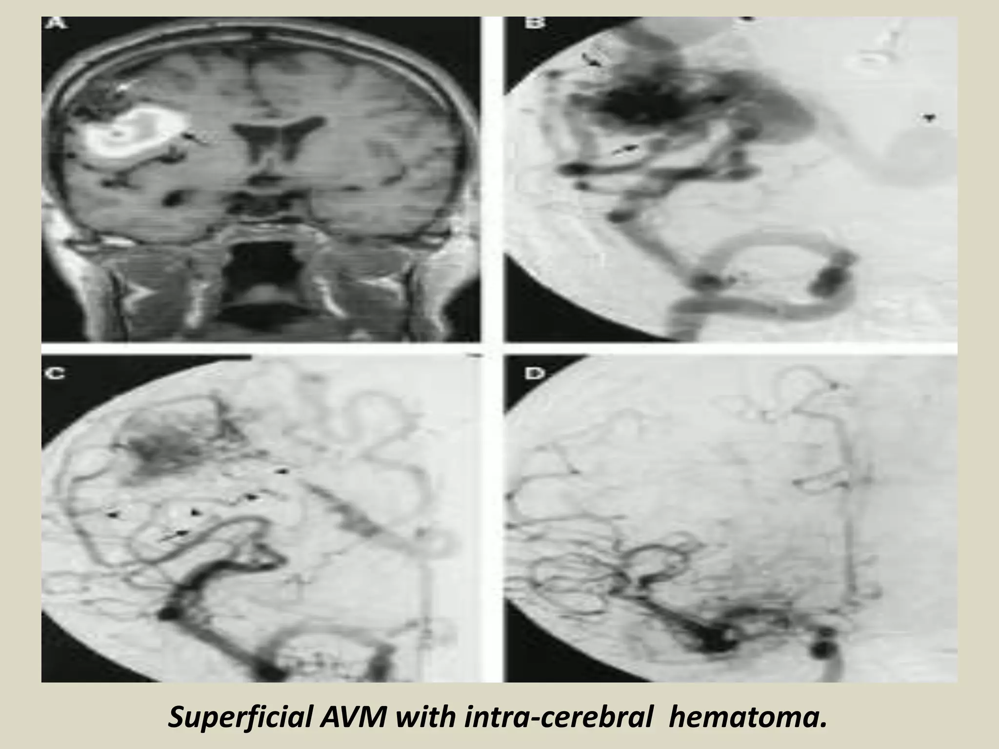 Presentation1.pptx, radiological imaging of brain av malformation. | PPTX
