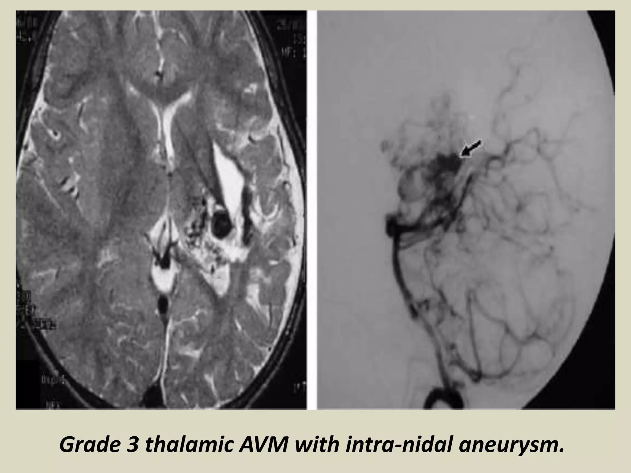 Presentation1.pptx, radiological imaging of brain av malformation. | PPTX