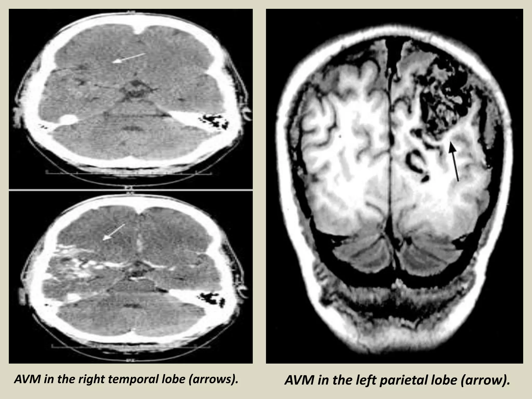 Presentation1.pptx, radiological imaging of brain av malformation. | PPTX