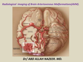 Presentation1.pptx, radiological imaging of brain av malformation. | PPTX