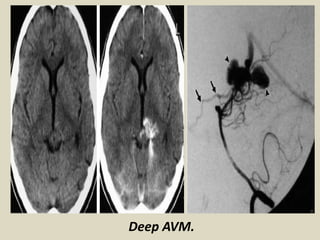 Presentation1.pptx, radiological imaging of brain av malformation. | PPTX