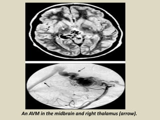 Presentation1.pptx, radiological imaging of brain av malformation. | PPTX