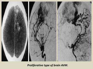 Presentation1.pptx, radiological imaging of brain av malformation. | PPTX