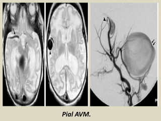 Presentation1.pptx, radiological imaging of brain av malformation. | PPTX