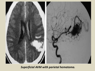 Presentation1.pptx, radiological imaging of brain av malformation. | PPTX