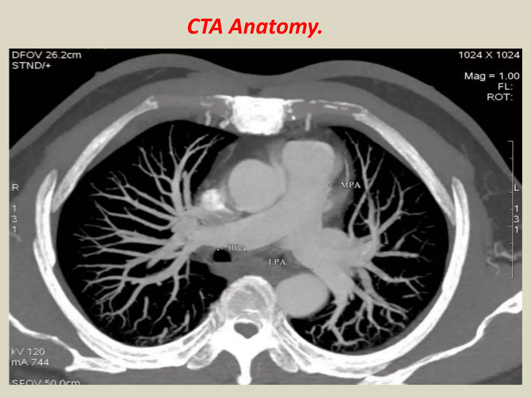 Presentation1.pptx, radiological imaging of pulmonary embolism. | PPTX