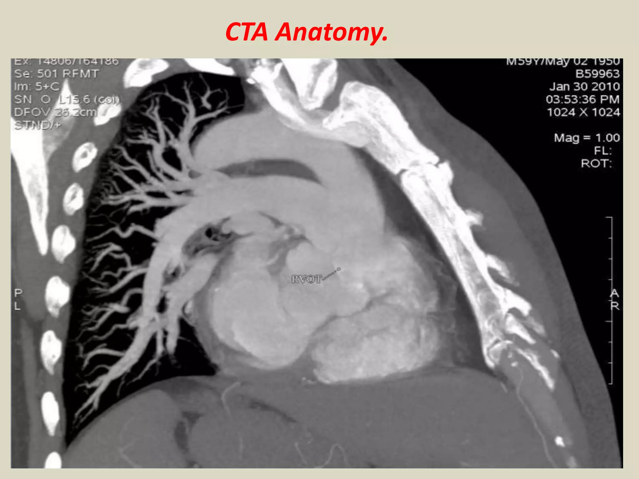 Presentation1.pptx, radiological imaging of pulmonary embolism. | PPTX