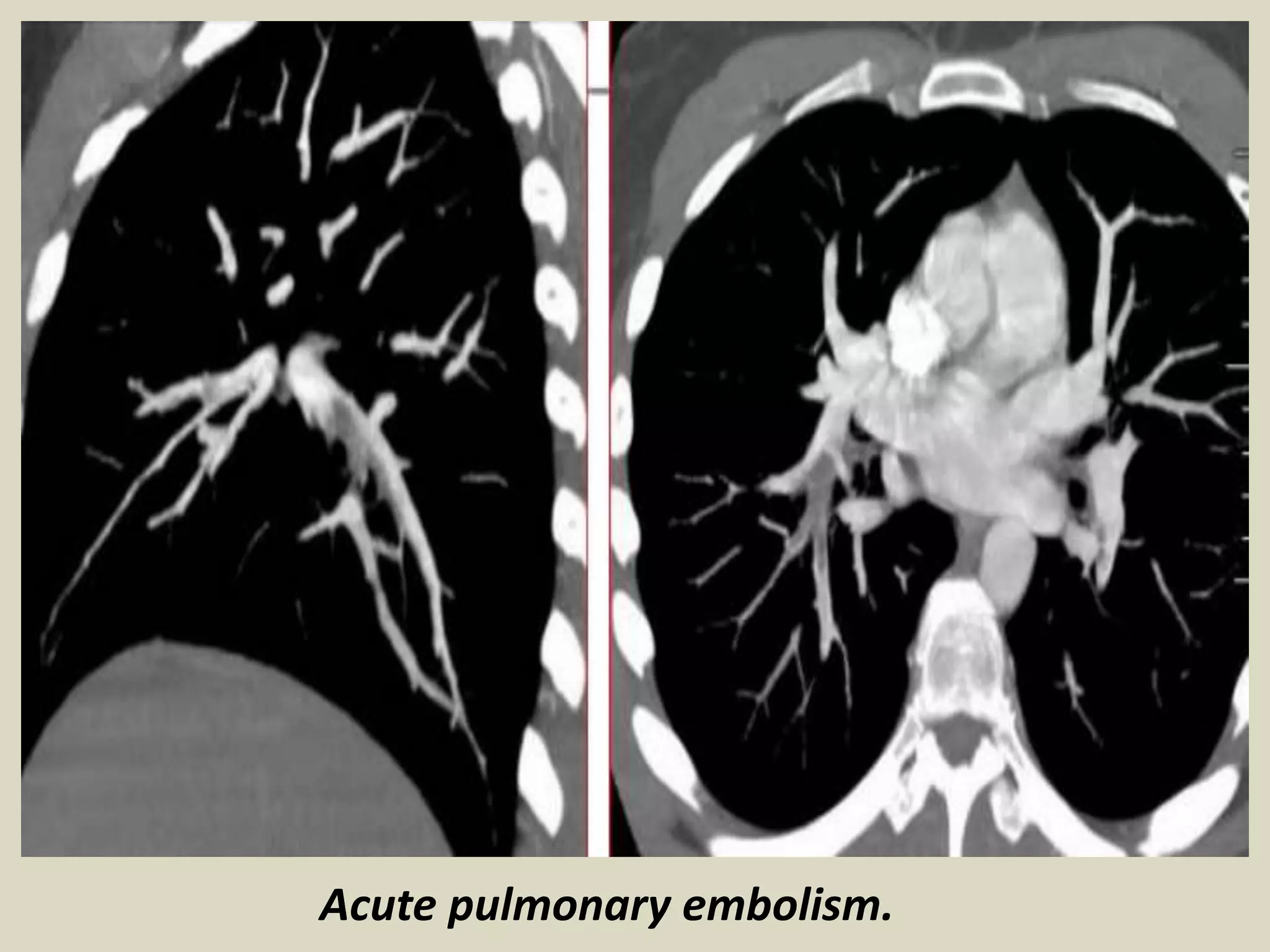 Presentation1.pptx, radiological imaging of pulmonary embolism. | PPTX