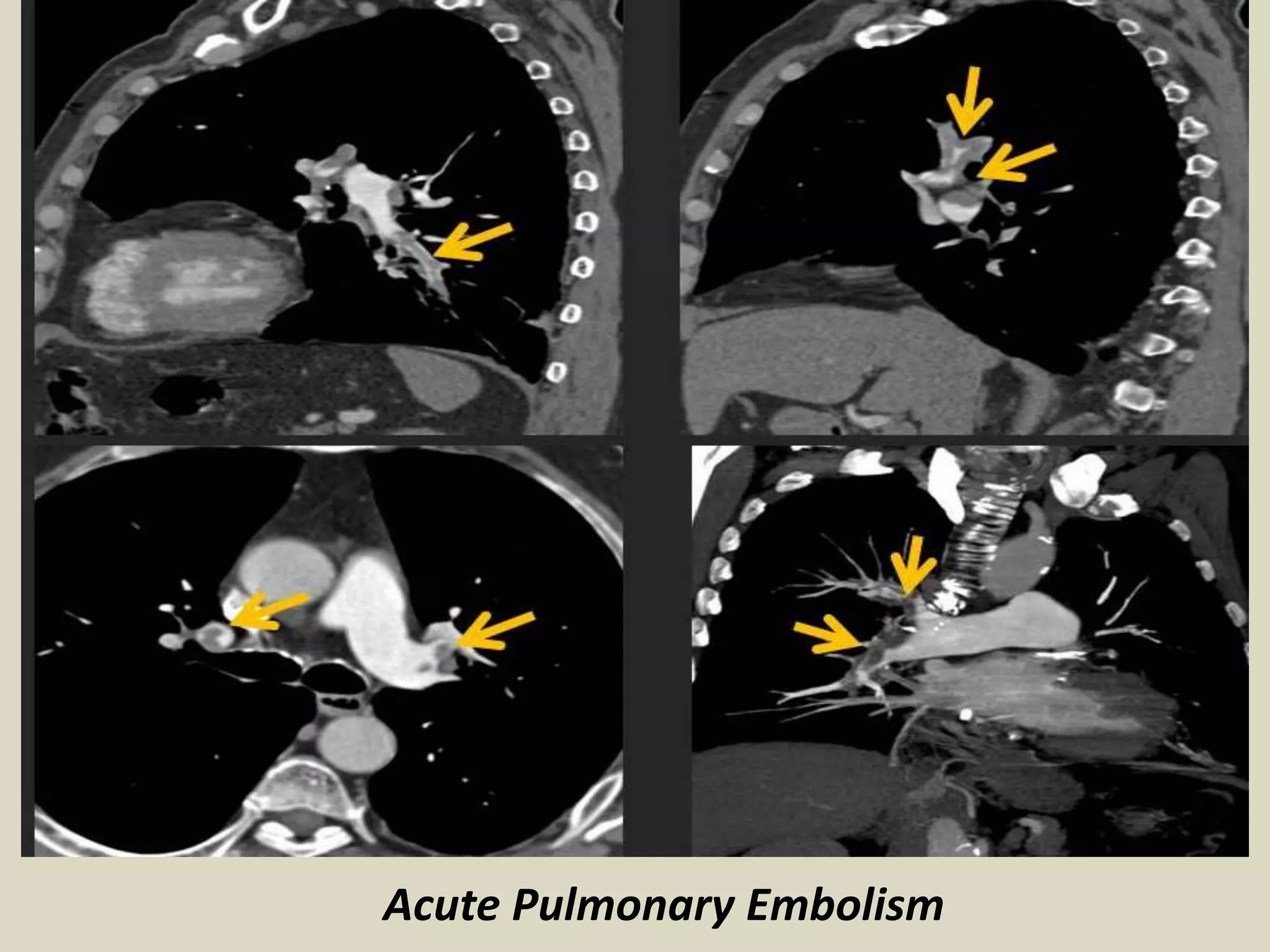 Presentation1.pptx, radiological imaging of pulmonary embolism. | PPTX