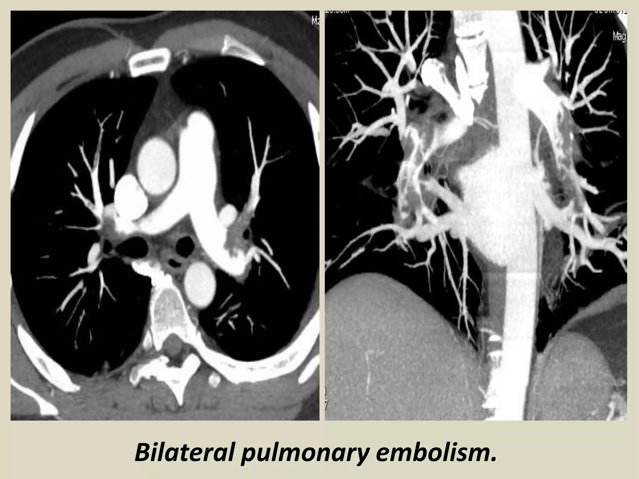 Presentation1.pptx, radiological imaging of pulmonary embolism. | PPTX