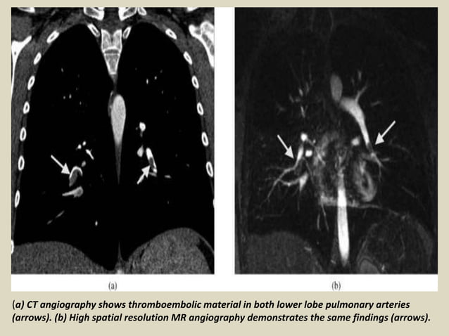Presentation1.pptx, radiological imaging of pulmonary embolism.