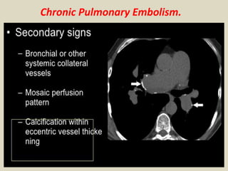 Saddle Pulmonary Embolism Xray