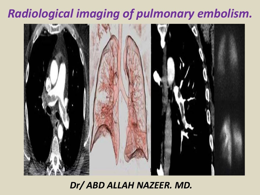Presentation1.pptx, radiological imaging of pulmonary embolism.