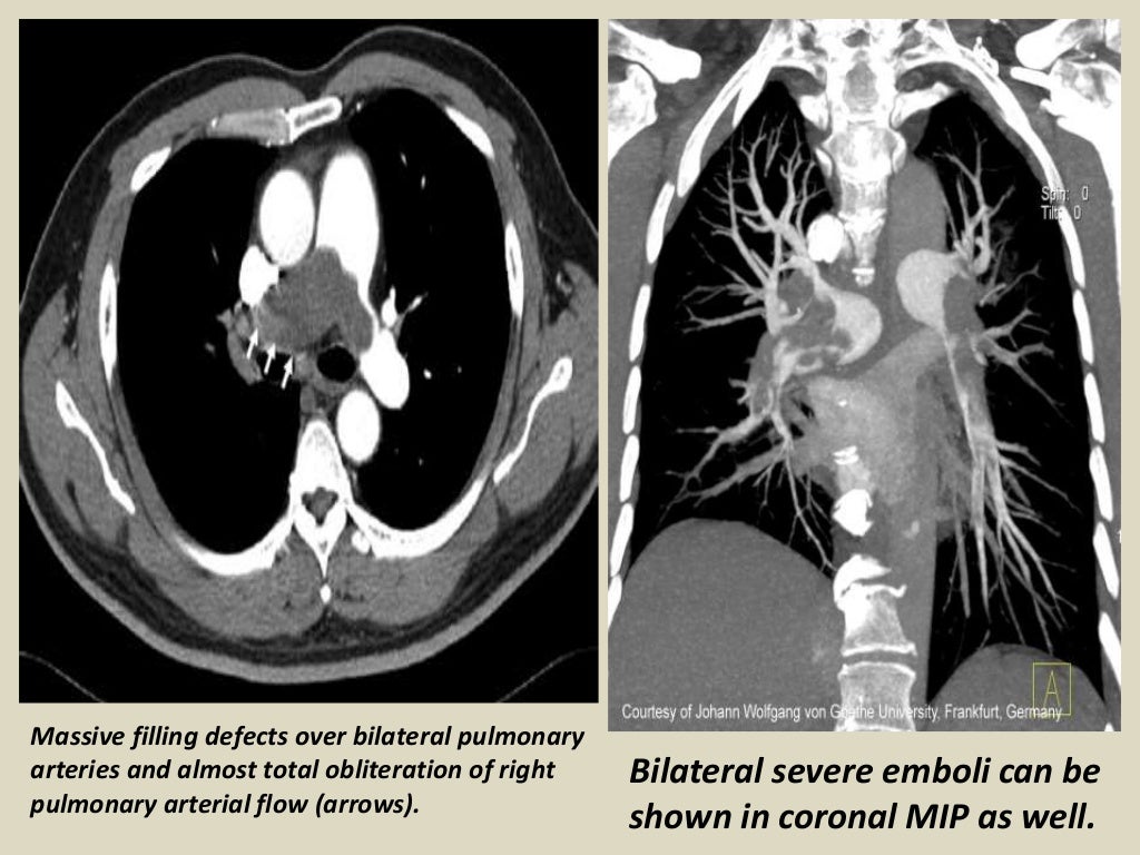 Presentation1.pptx, radiological imaging of pulmonary embolism.