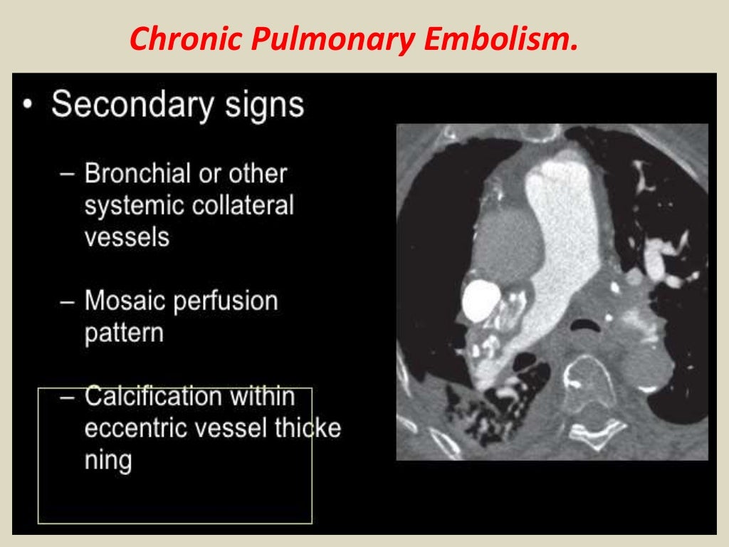 Presentation1.pptx, radiological imaging of pulmonary embolism.