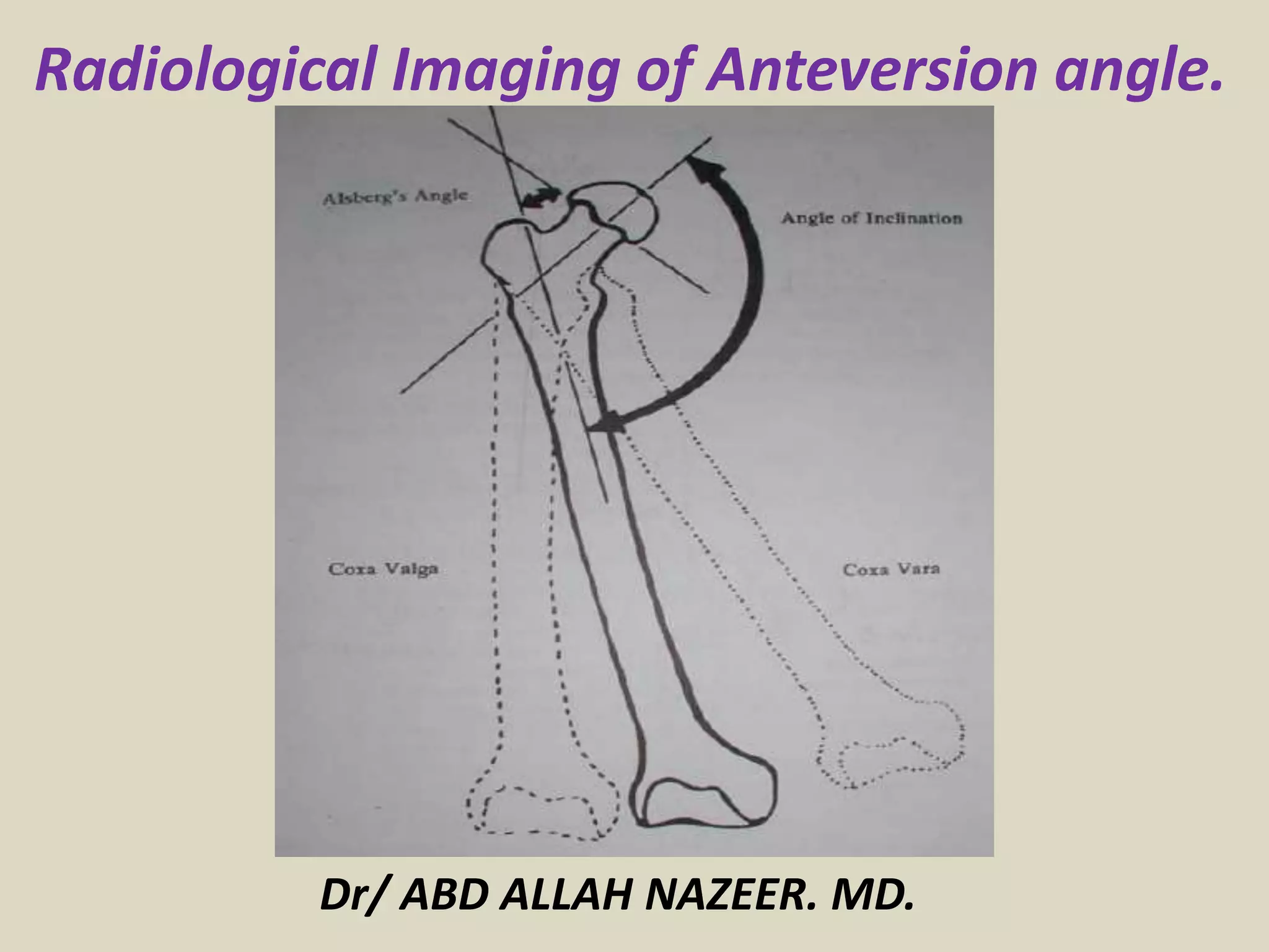 Presentation1.pptx, radiological imaging of anteversion angle. | PPT