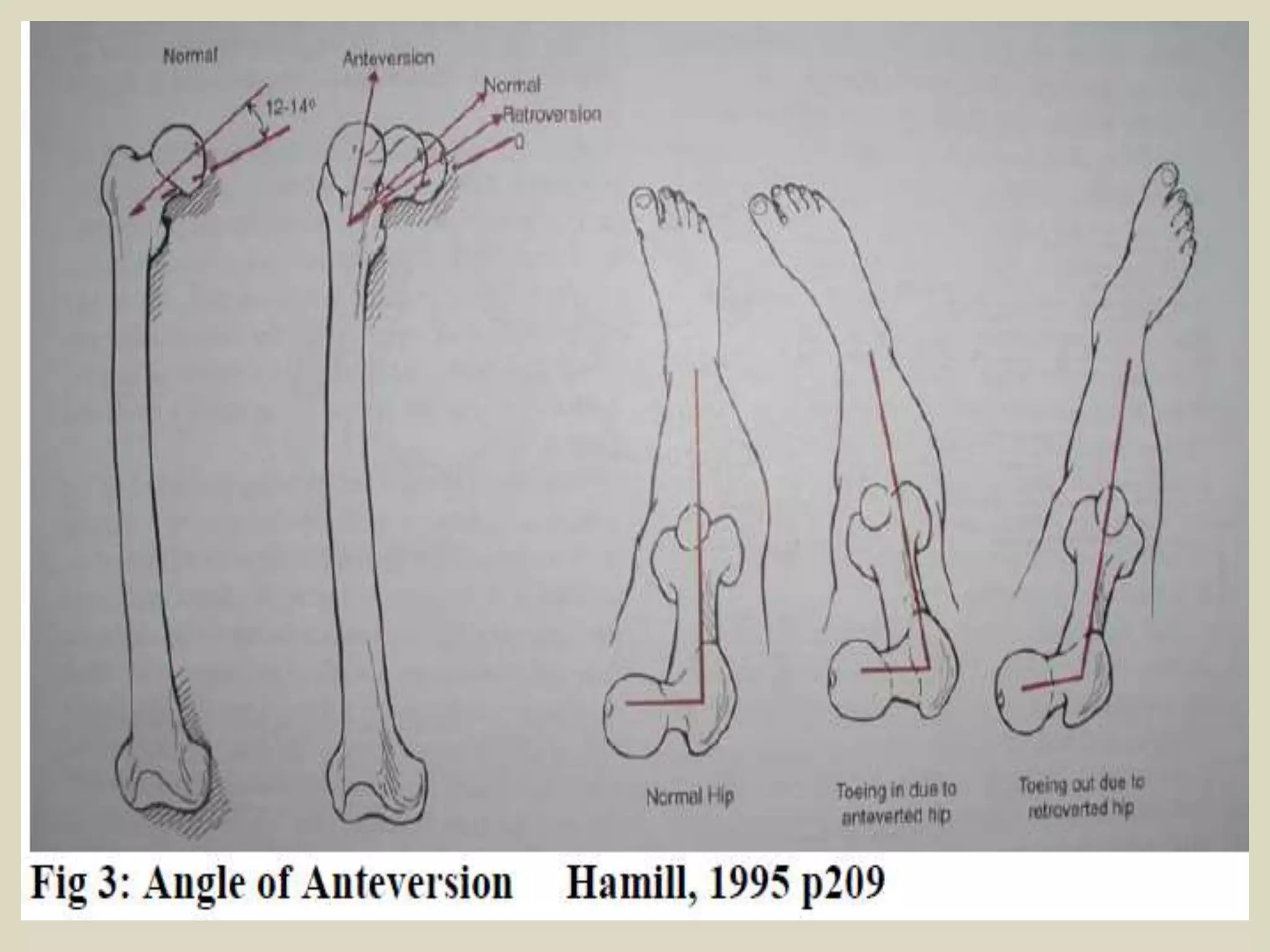 Presentation1.pptx, radiological imaging of anteversion angle. | PPTX