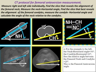 Presentation1.pptx, radiological imaging of anteversion angle. | PPT