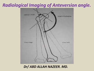 Femoral Anteversion Angle