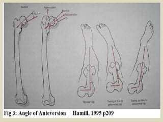 Femoral Anteversion Angle