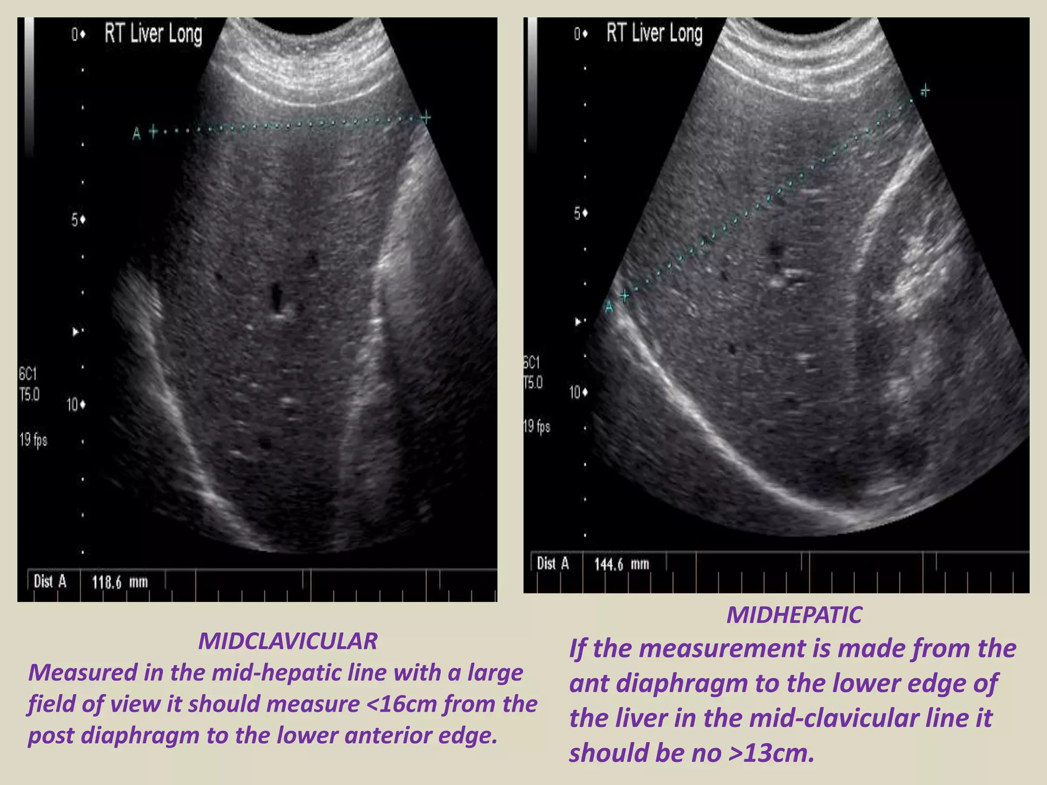 Presentation1.pptx, ultrasound examination of the liver and gall ...